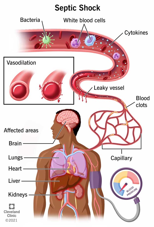 Iv Infiltration Blanching